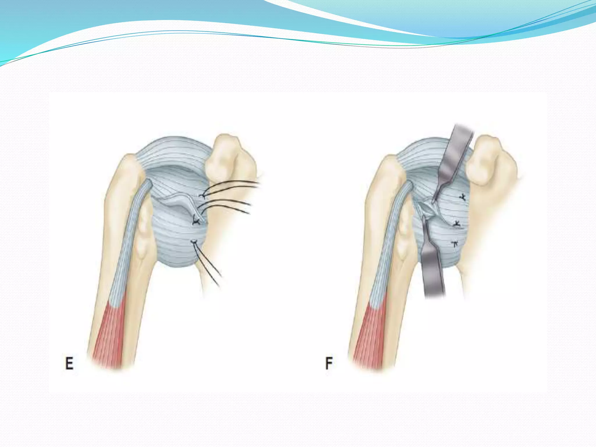 Recurrent Shoulder Dislocation | PPTX