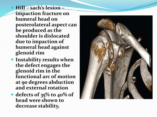 Recurrent Shoulder Dislocation | PPTX