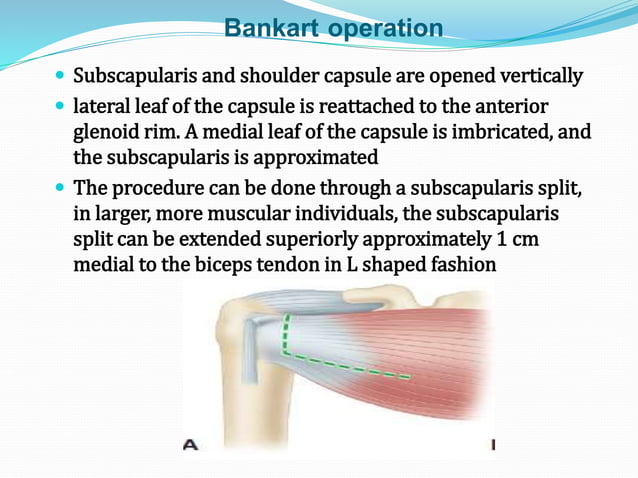 Recurrent Shoulder Dislocation | PPTX