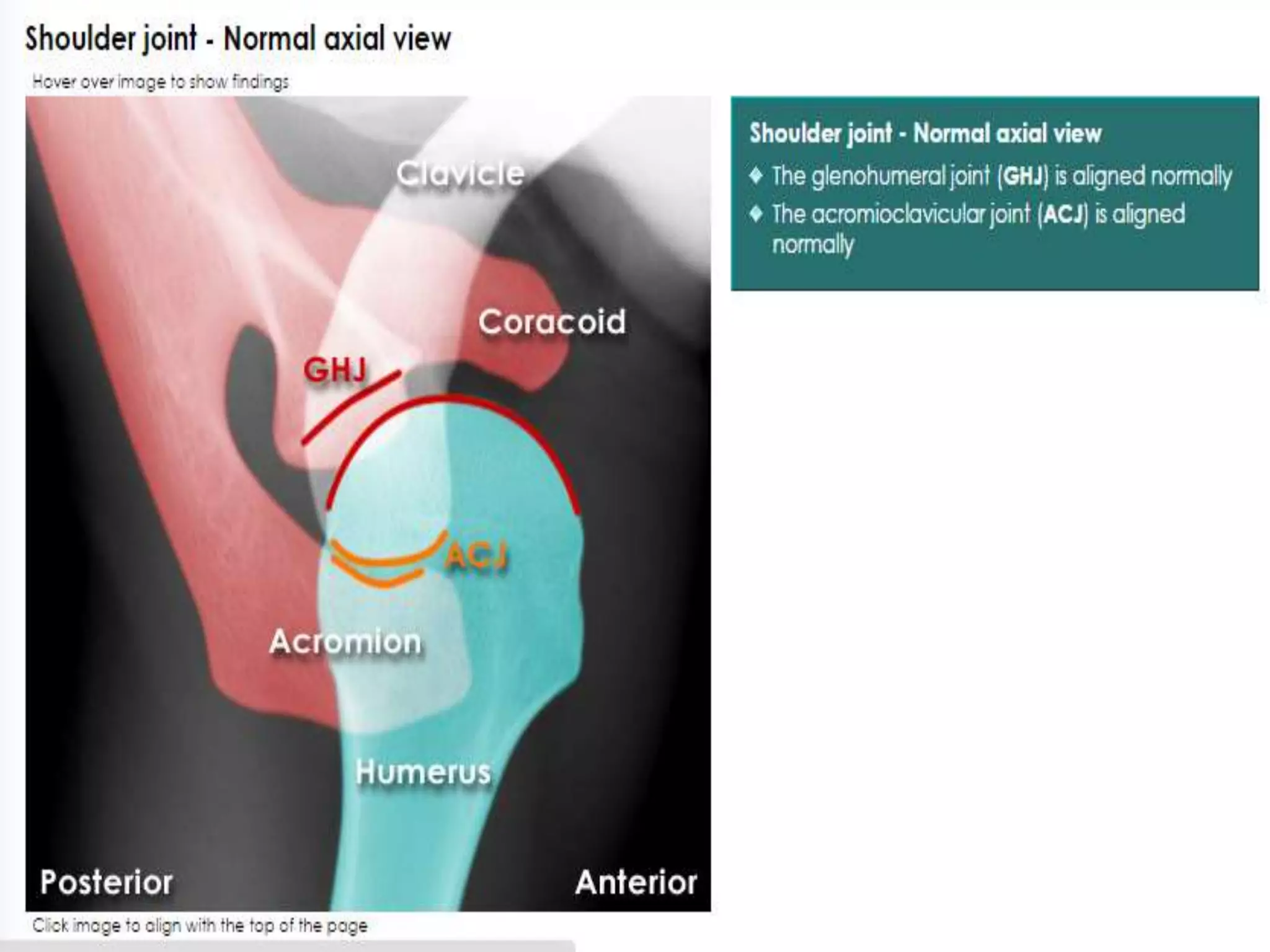 Recurrent shoulder dislocation | PPTX