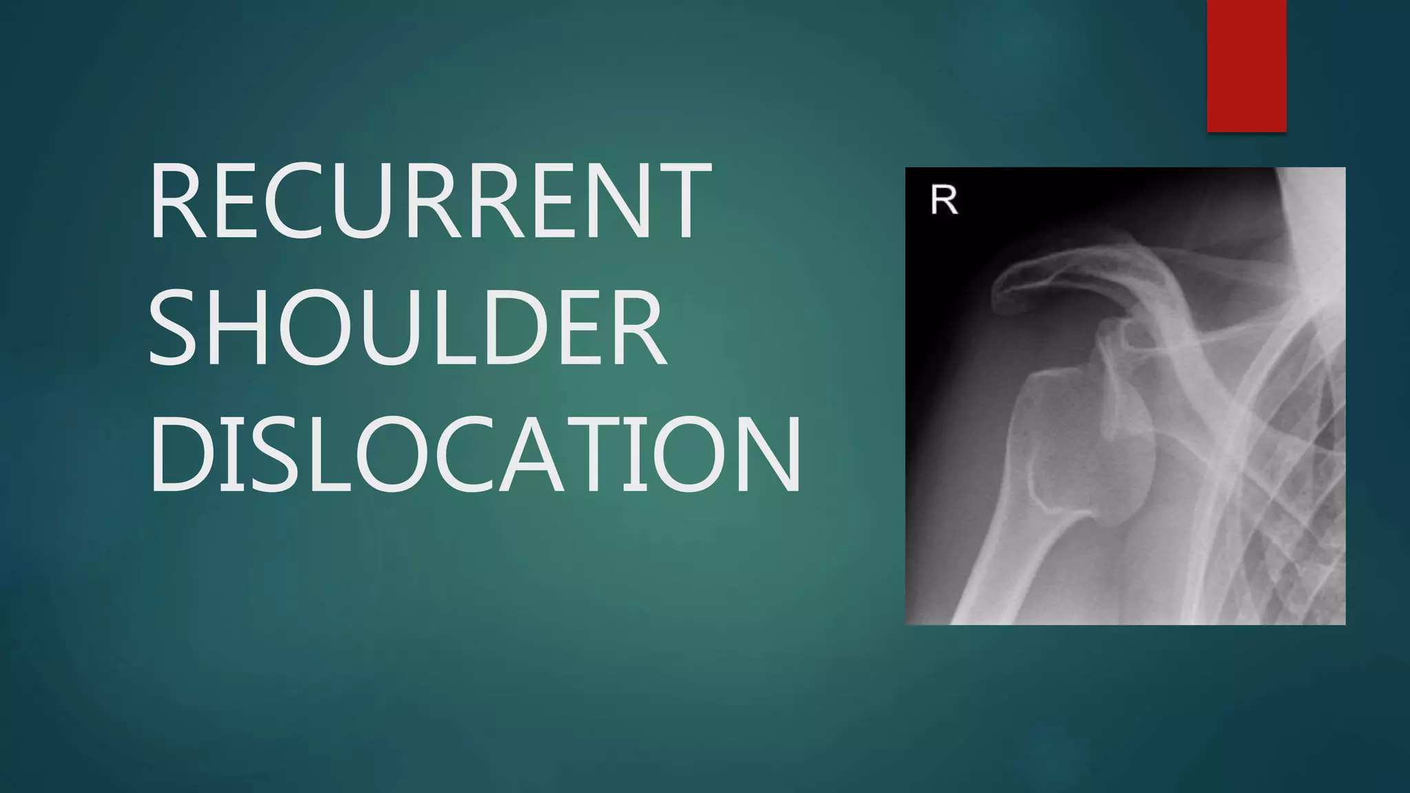 Recurrent shoulder dislocation and management | PPTX