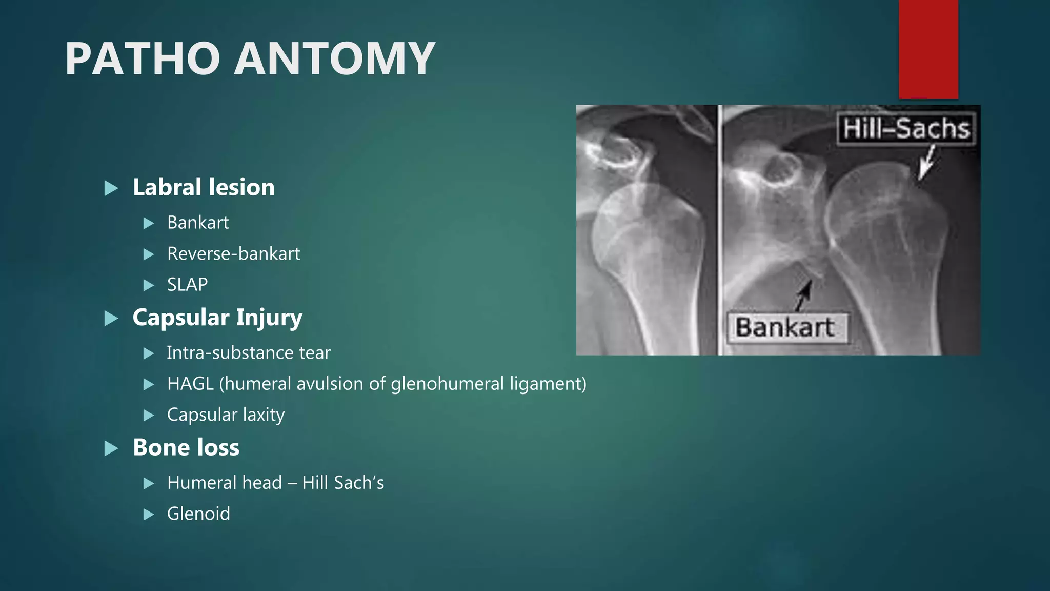 Recurrent shoulder dislocation and management | PPTX