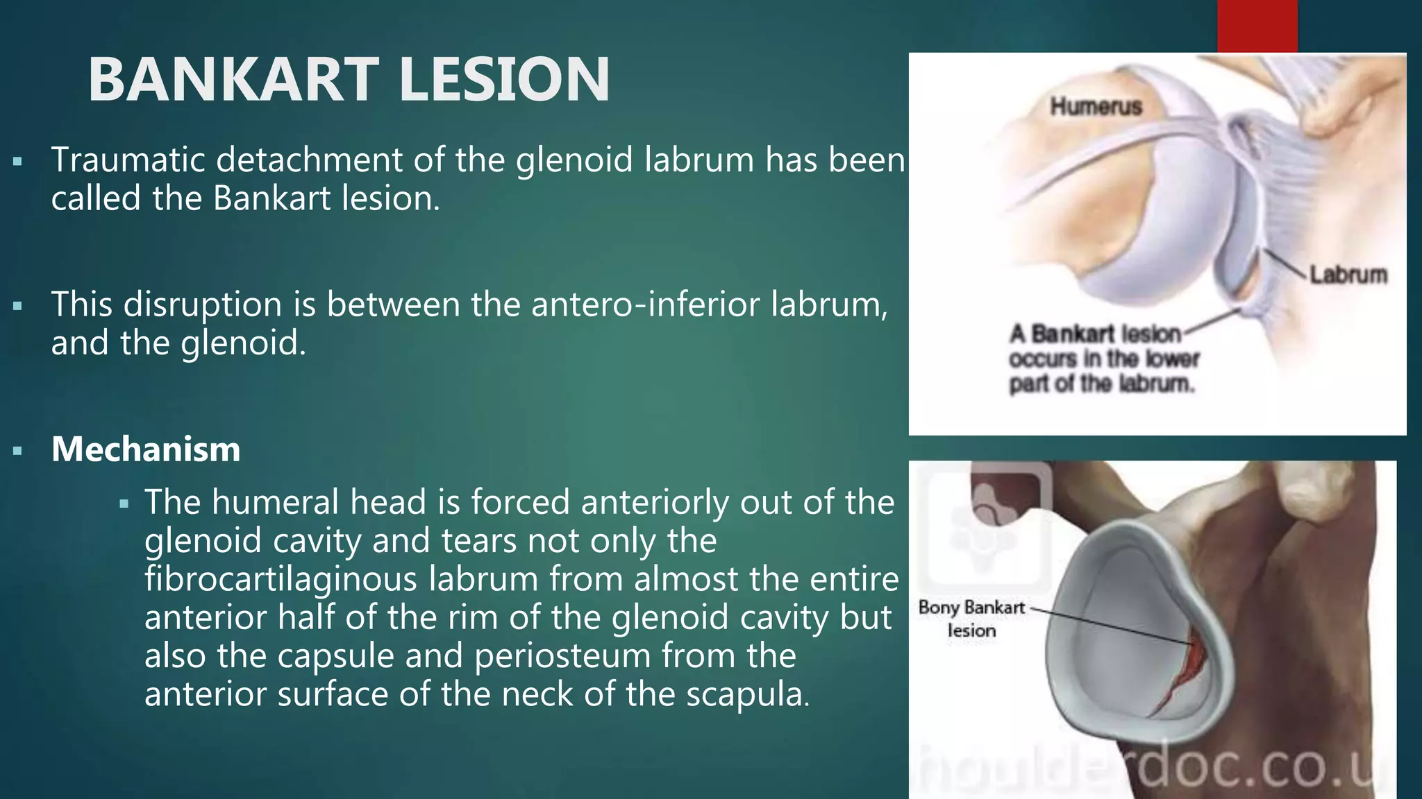Recurrent shoulder dislocation and management | PPTX