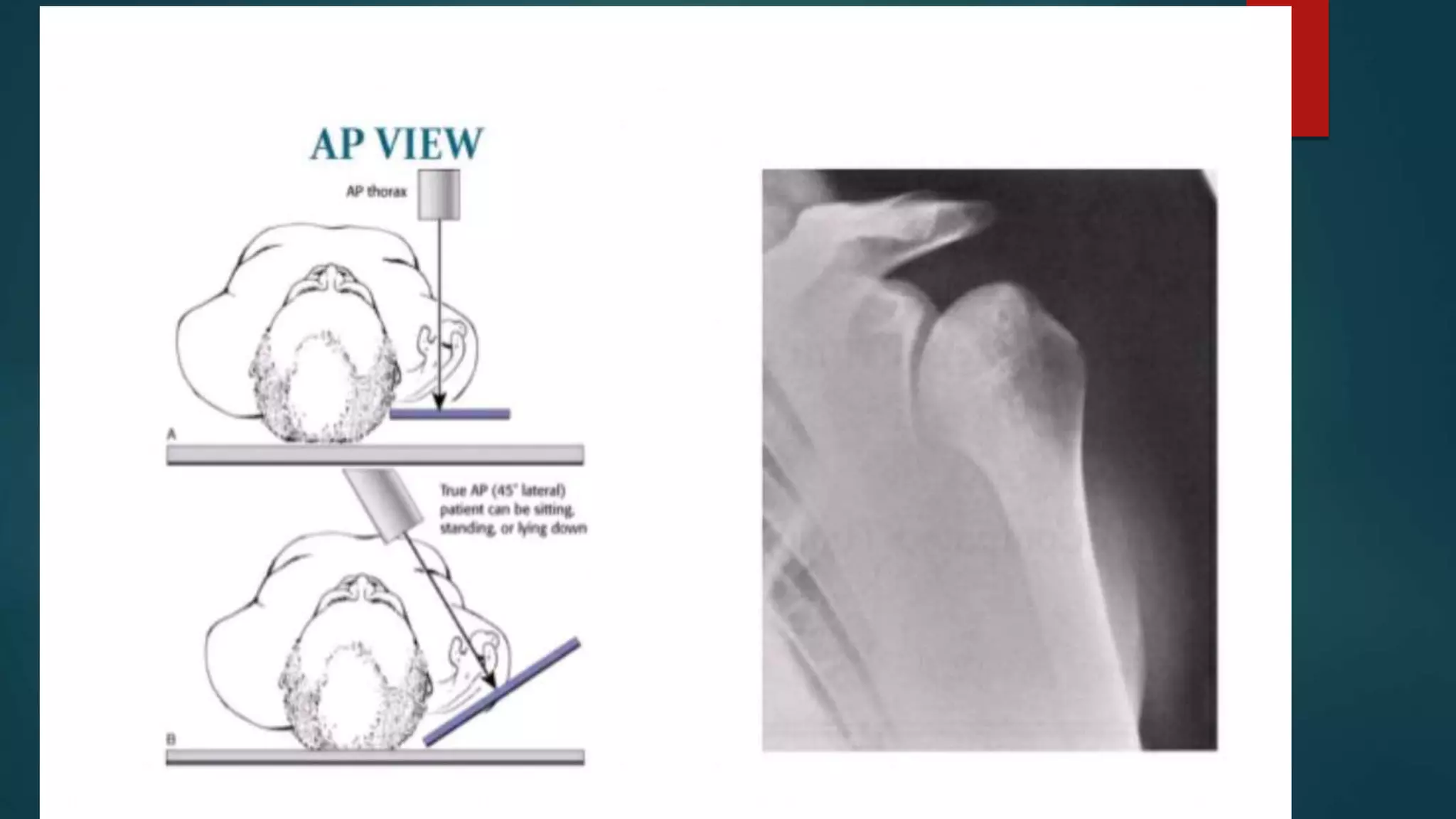 Recurrent shoulder dislocation and management | PPTX