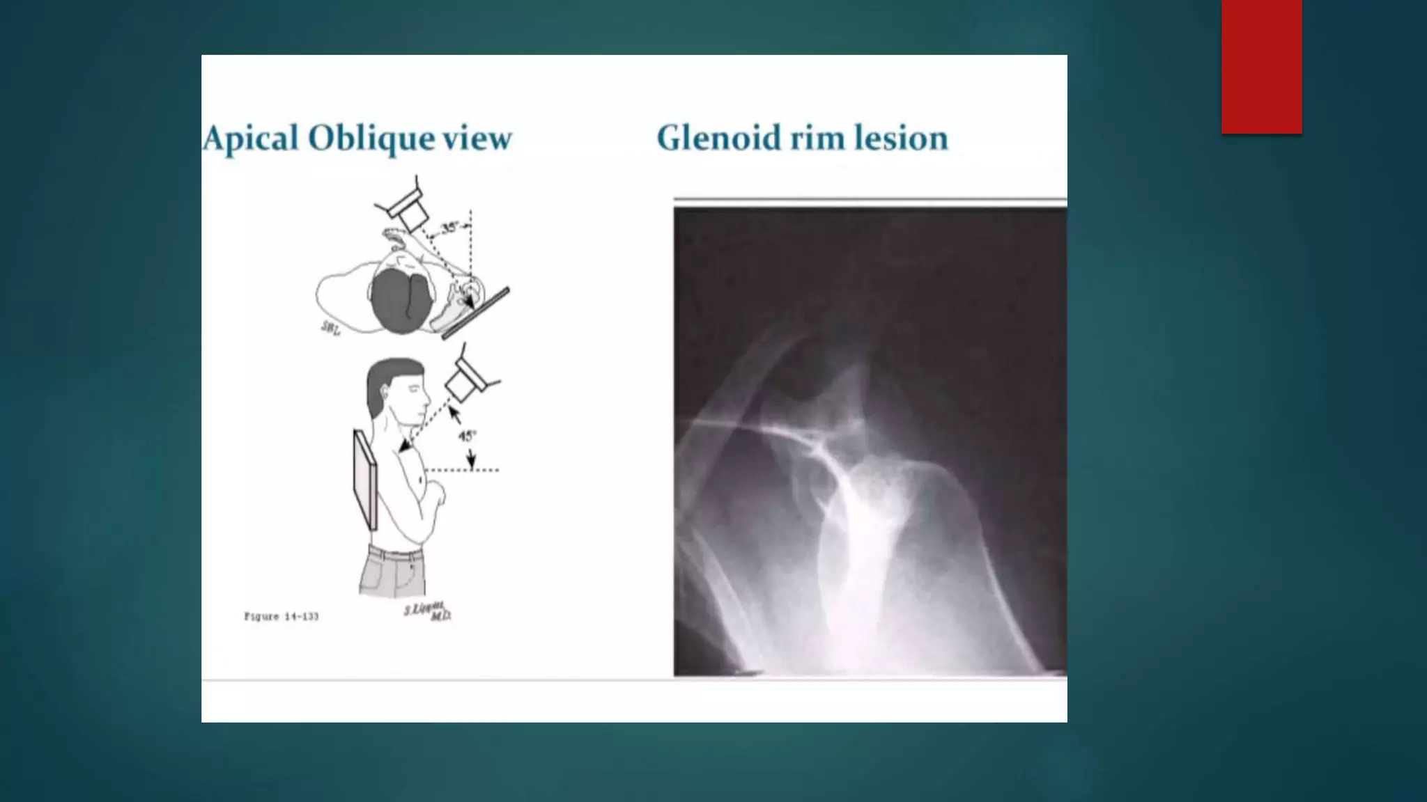 Recurrent shoulder dislocation and management | PPTX