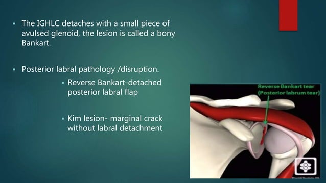 Recurrent shoulder dislocation and management | PPTX