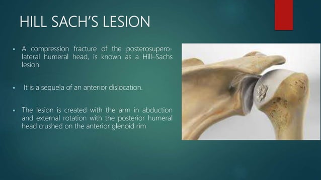 Recurrent shoulder dislocation and management | PPTX