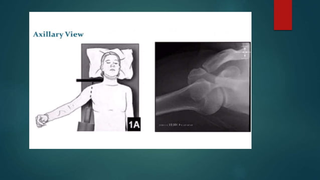Recurrent shoulder dislocation and management | PPTX