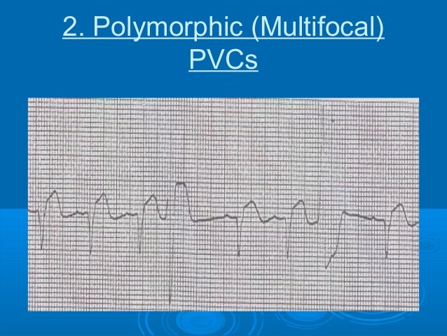 Recurrent ventricular arrhythmia after cardiac surgery