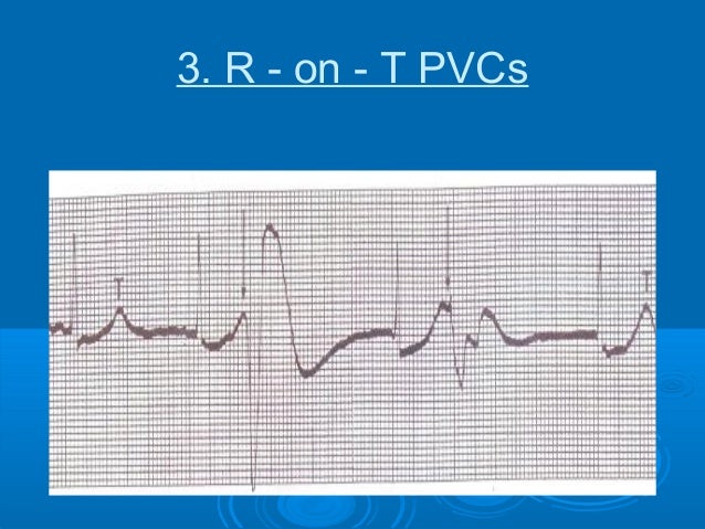 Recurrent ventricular arrhythmia after cardiac surgery