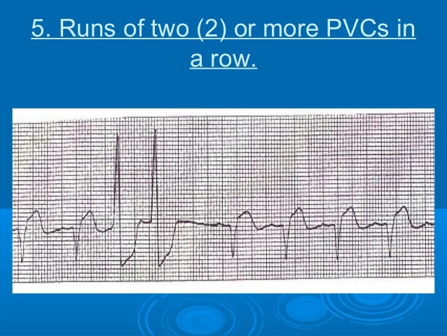Recurrent ventricular arrhythmia after cardiac surgery