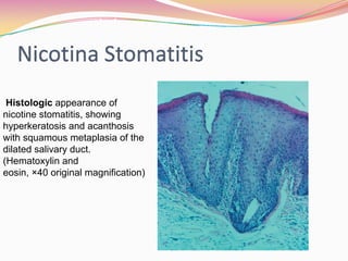 Nicotine Stomatitis Histopathology