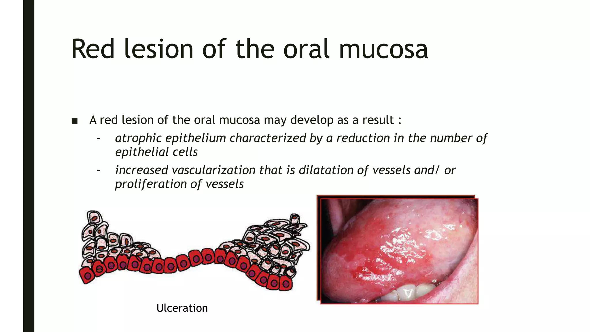 RED AND WHITE LESIONS OF THE ORAL MUCOSA.pptx