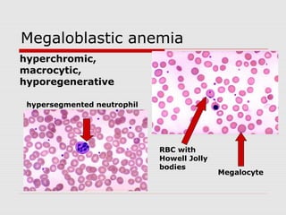 Pernicious Anemia Histology
