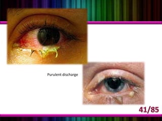 Mucopurulent Discharge Eye