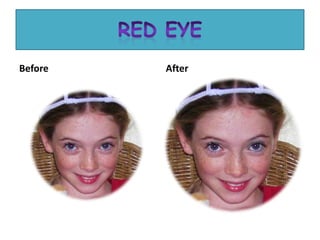 Red eye | PPT