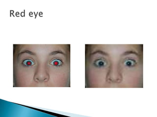 Red eye | PPT