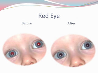 Red Eye Powerpoint Presentation | PPT