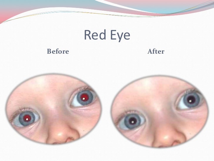 Red Eye Powerpoint Presentation