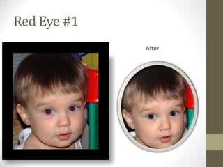 Red eye | PPTX