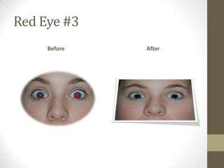 Red eye | PPTX