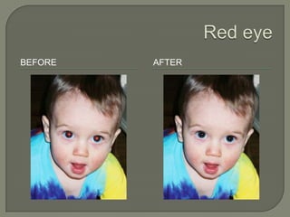 Red eye | PPT