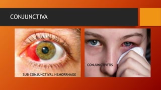 Red eye | PPTX