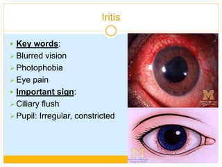 Ciliary Flush Vs Conjunctivitis