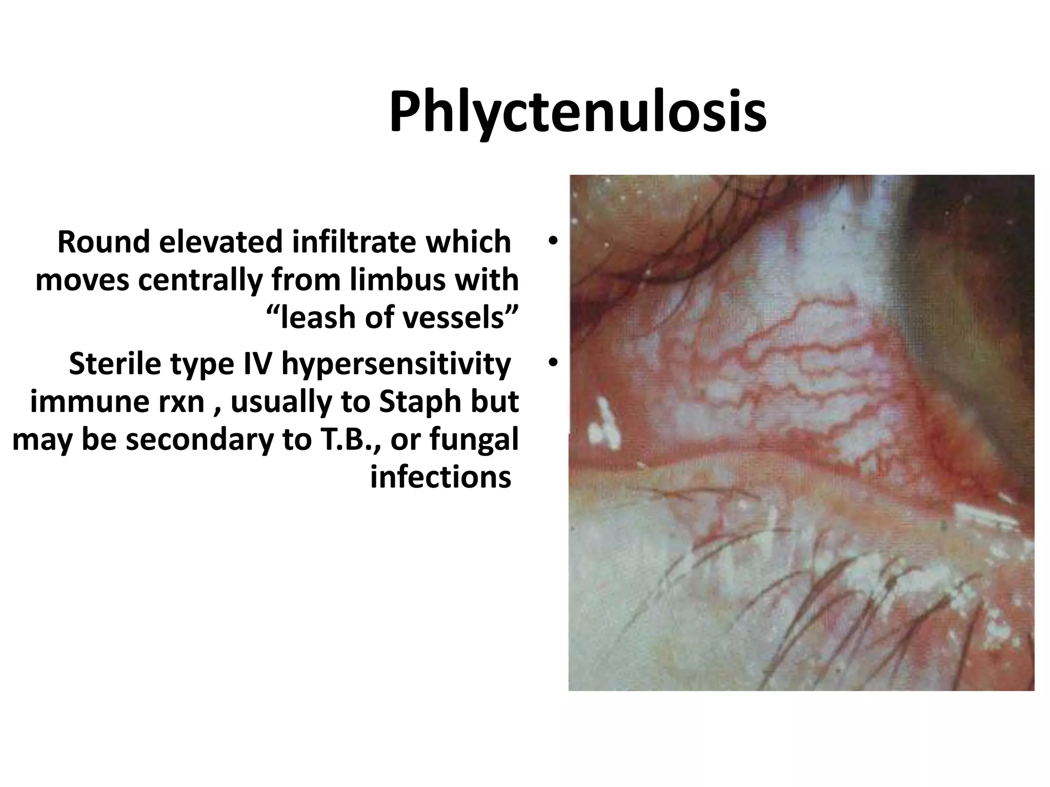 Red eye syndrome | PPSX