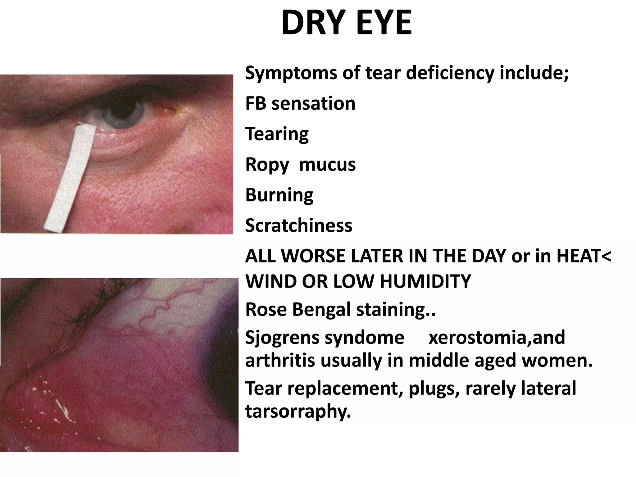 Red eye syndrome | PPSX