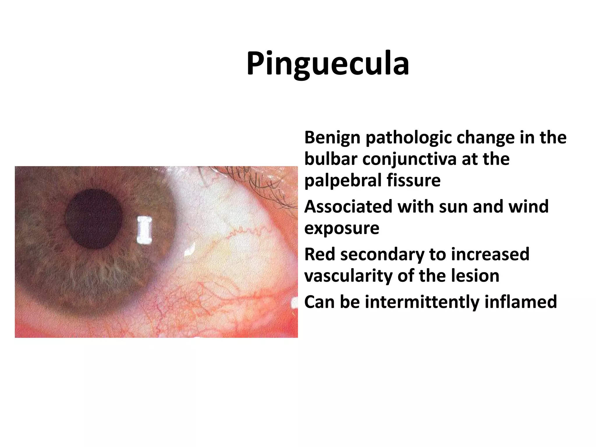 Red eye syndrome | PPSX