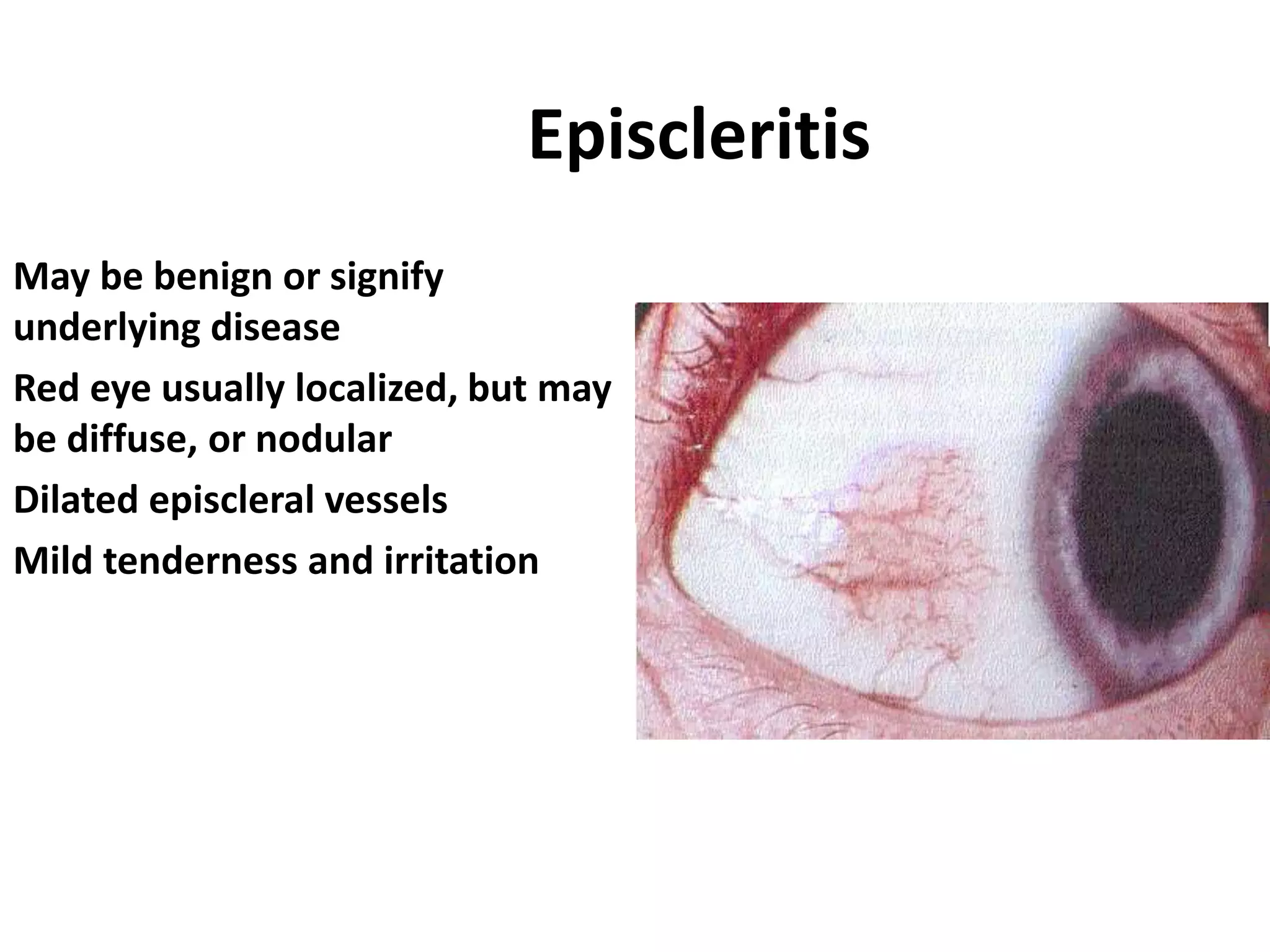 Red eye syndrome | PPSX