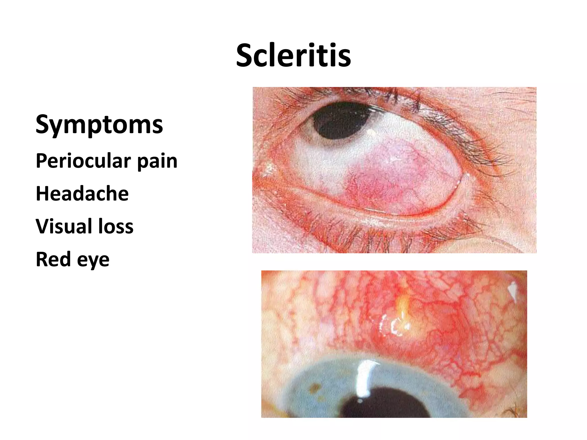 Red eye syndrome | PPSX