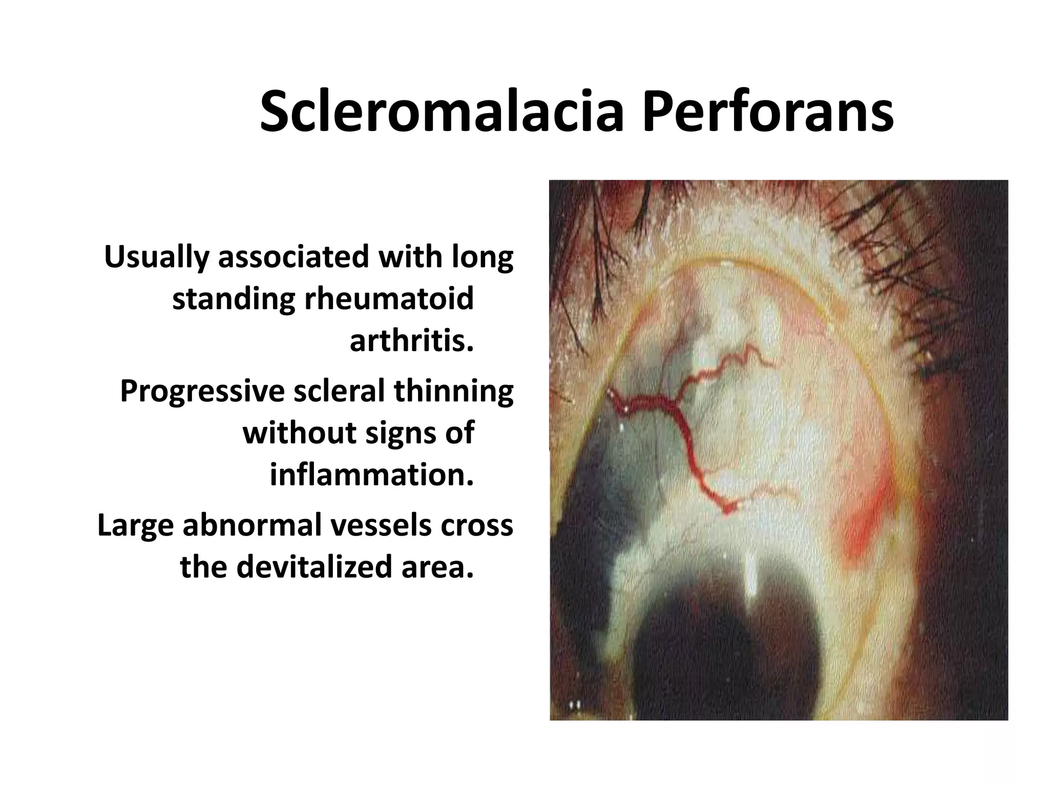 Red eye syndrome | PPSX