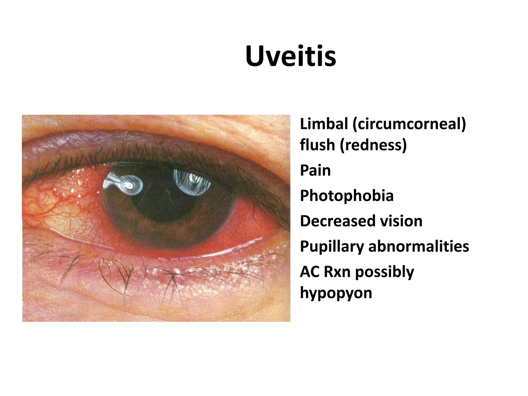 Red eye syndrome | PPSX