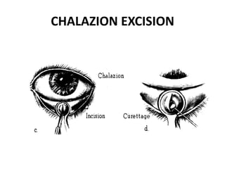 Red eye syndrome | PPSX