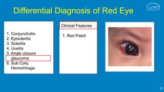 Red eye | PPTX