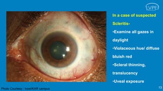 Red eye | PPTX
