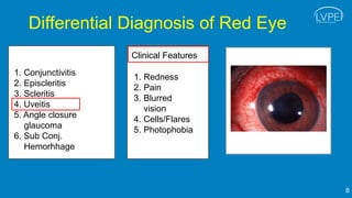 Red eye | PPTX
