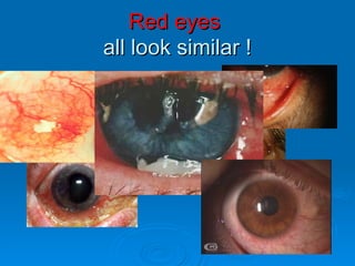 RED EYE - Copy. presentation (conjunctivitis) | PPT