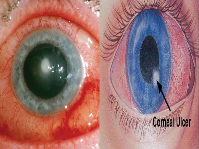 Red eye | PPTX | Eye and Vision Conditions | Diseases and Conditions