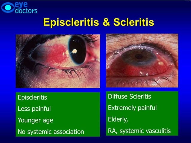 Red eye | PPTX | Eye and Vision Conditions | Diseases and Conditions