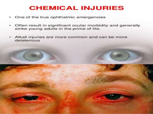 Red eye | PPTX | Eye and Vision Conditions | Diseases and Conditions