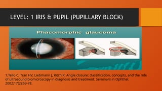 RED EYE AND ACUTE ANGLE CLOSURE GLAUCOMA.pptx