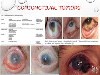 Ciliary Flush Vs Conjunctivitis