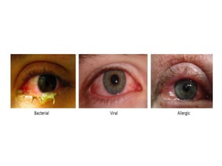 RED EYE in ophthalmology and its causess | PPT