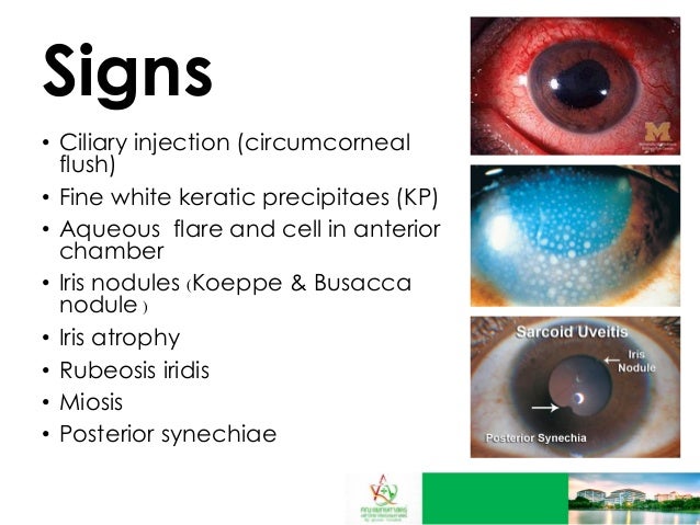 Red eye (high risk) by thann