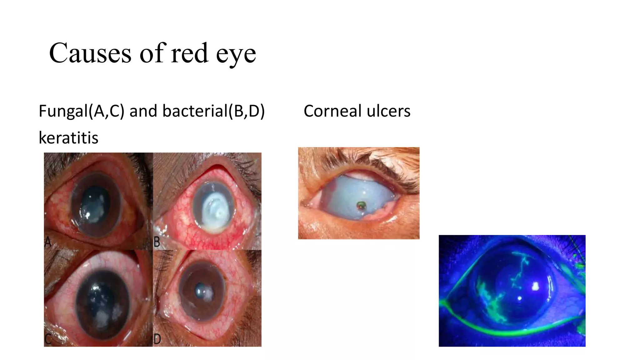 Red Eye - Common Causes, Diagnosis and Treatment.pptx
