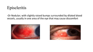 Red Eye - Common Causes, Diagnosis and Treatment.pptx