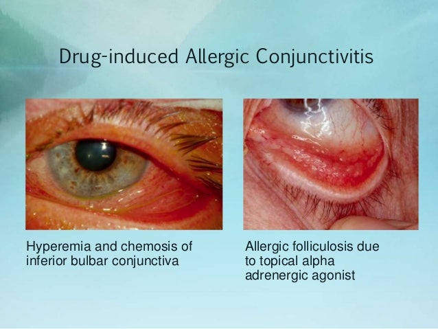 Evaluation of Red Eye; June 2014